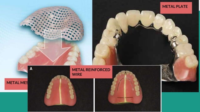 Dental polymers with recent advancements in dental base techniques 2 ...