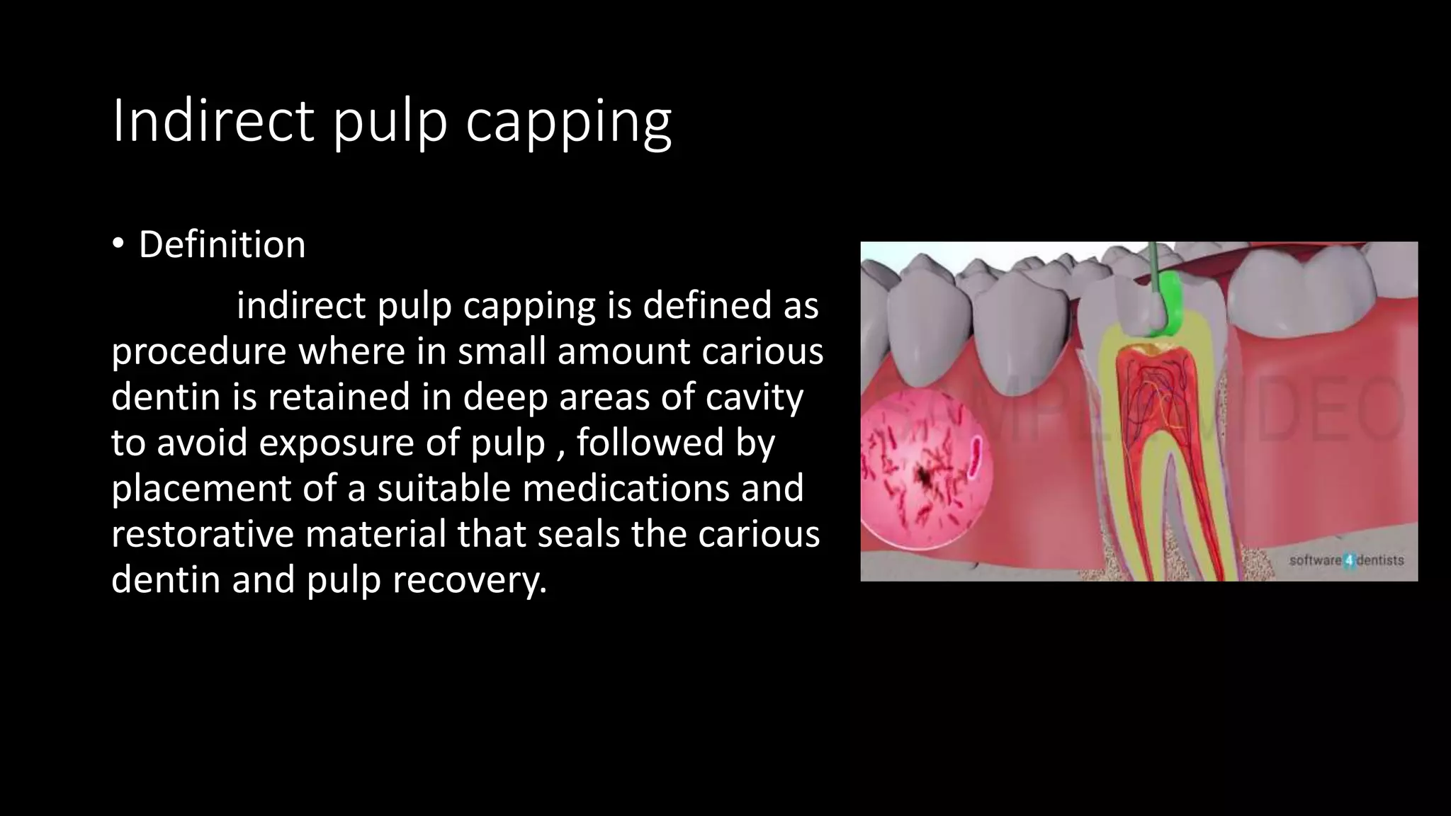 DENTAL PULP AND PULP CAPPING.pptx