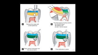 DENTAL PULP AND PULP CAPPING.pptx