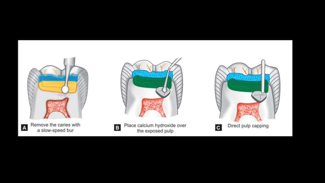 DENTAL PULP AND PULP CAPPING.pptx