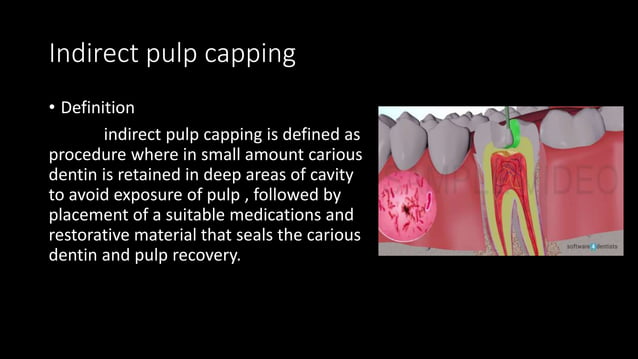 DENTAL PULP AND PULP CAPPING.pptx