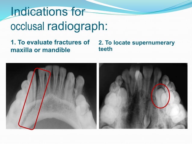 Dental radiology ppt | PPSX | Dental Health | Diseases and Conditions
