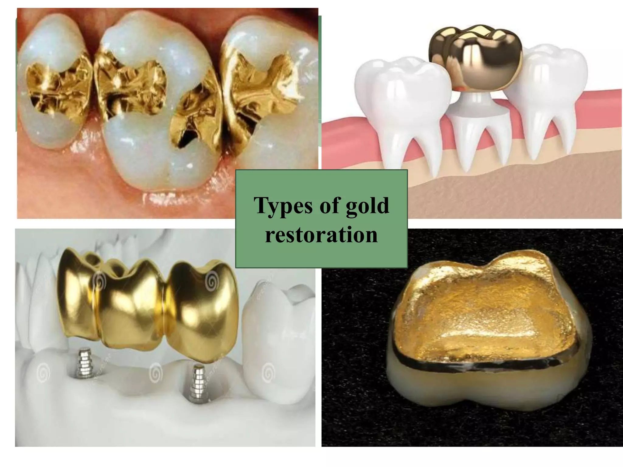 dental restorations.pptx
