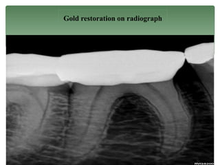 dental restorations.pptx