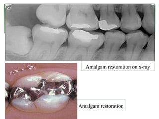 dental restorations.pptx