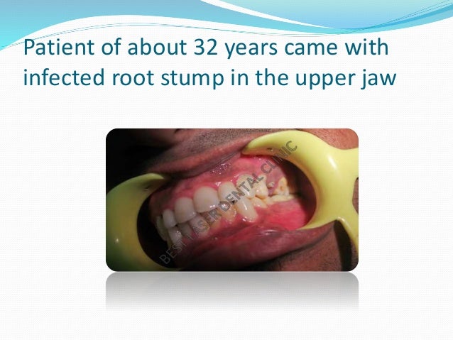 Dental root stump extraction and implant placement