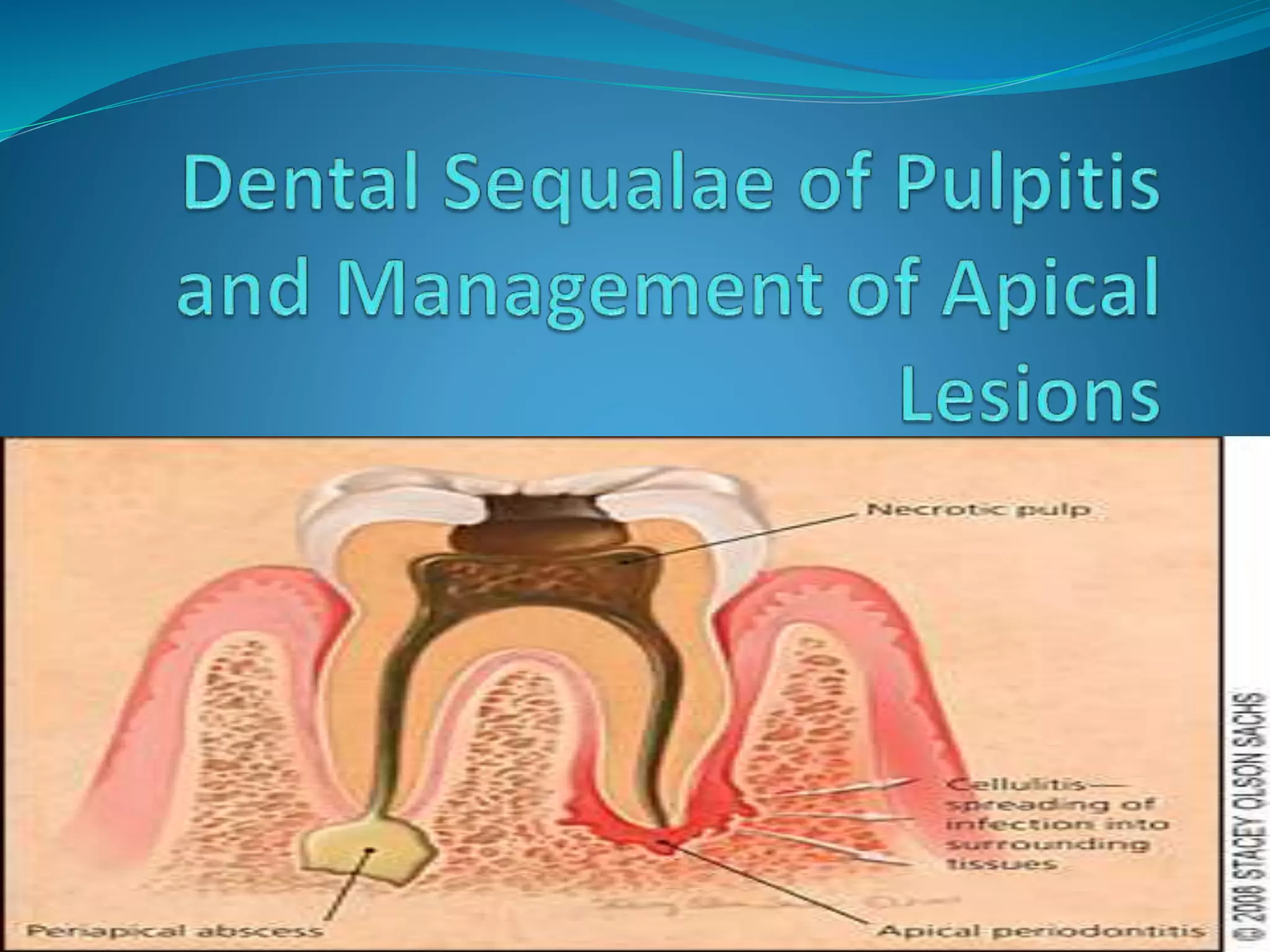 Dental sequalae of pulpitis and management of apical lesions | PPTX