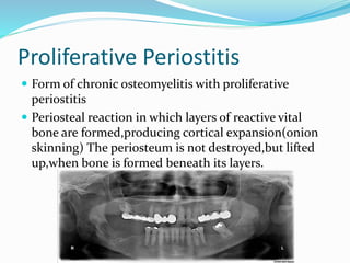 Dental sequalae of pulpitis and management of apical lesions | PPTX