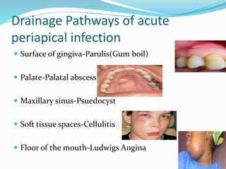 Dental sequalae of pulpitis and management of apical lesions | PPTX