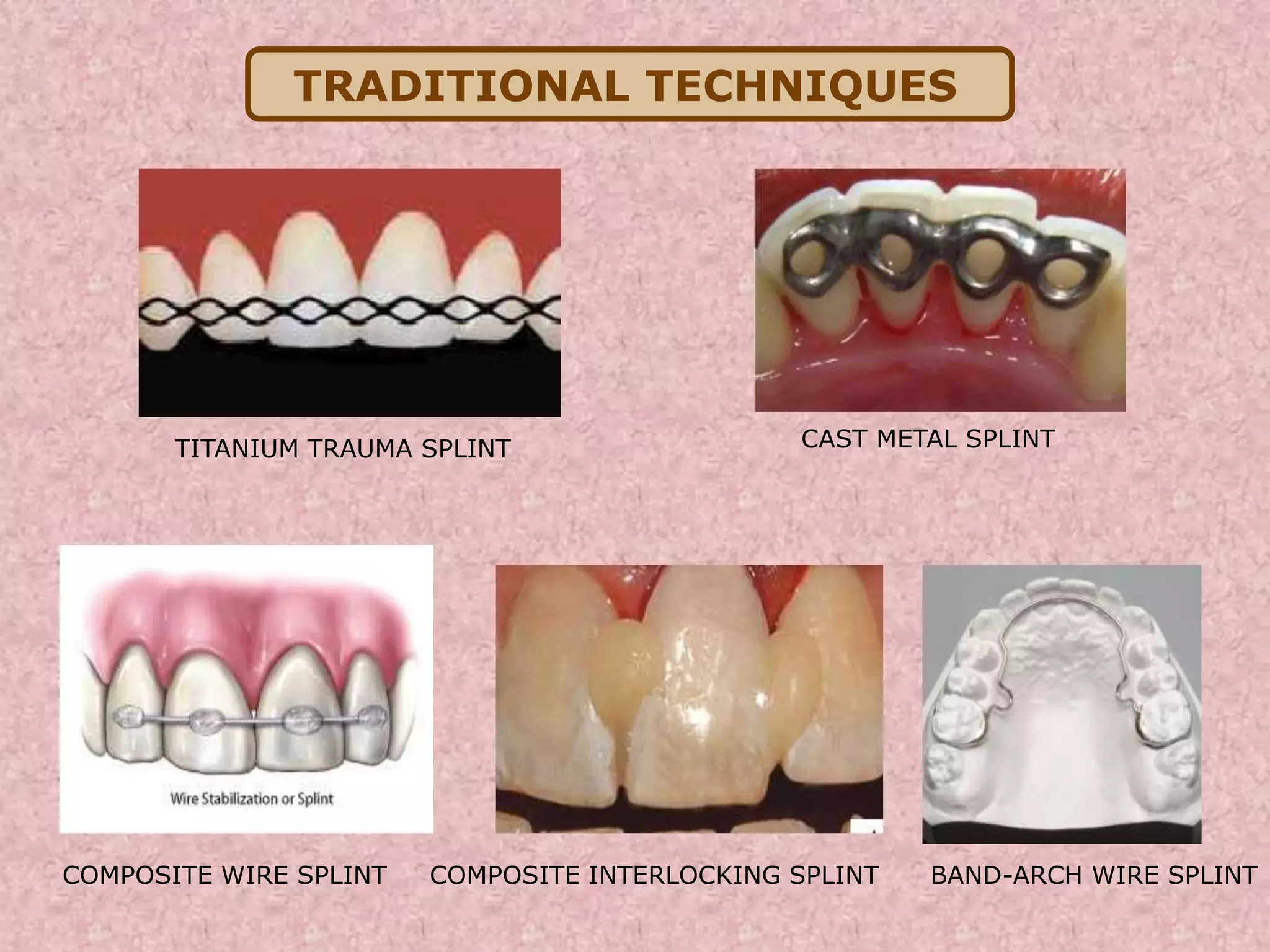 Dental splinting | PPTX