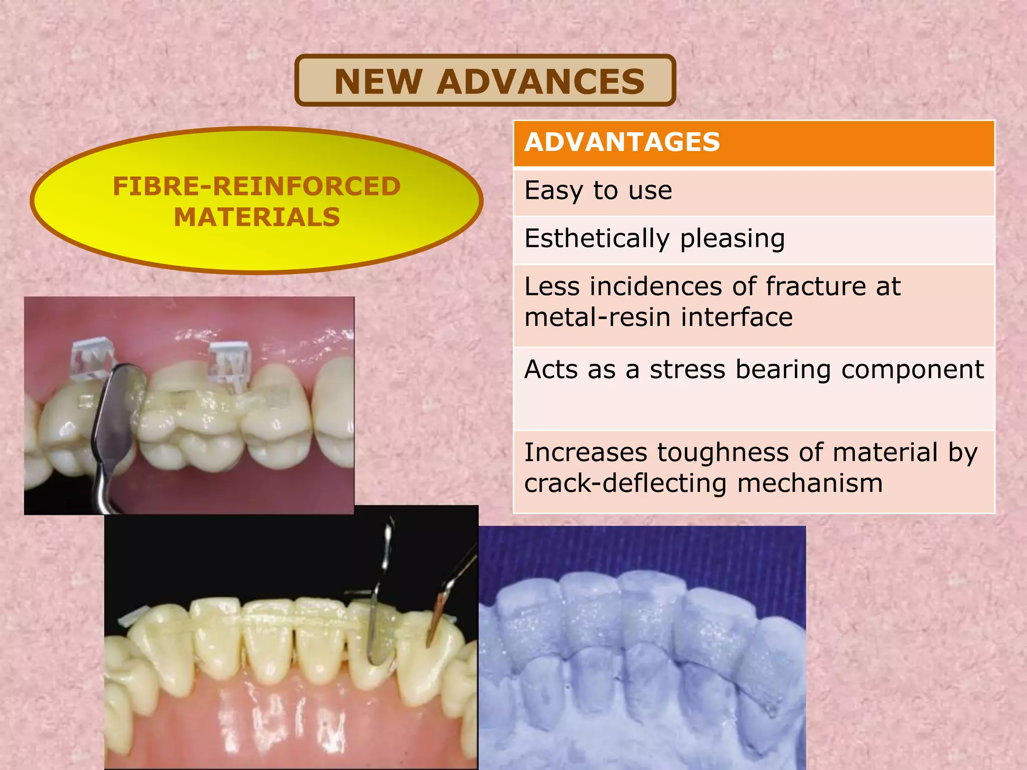 Dental splinting | PPTX