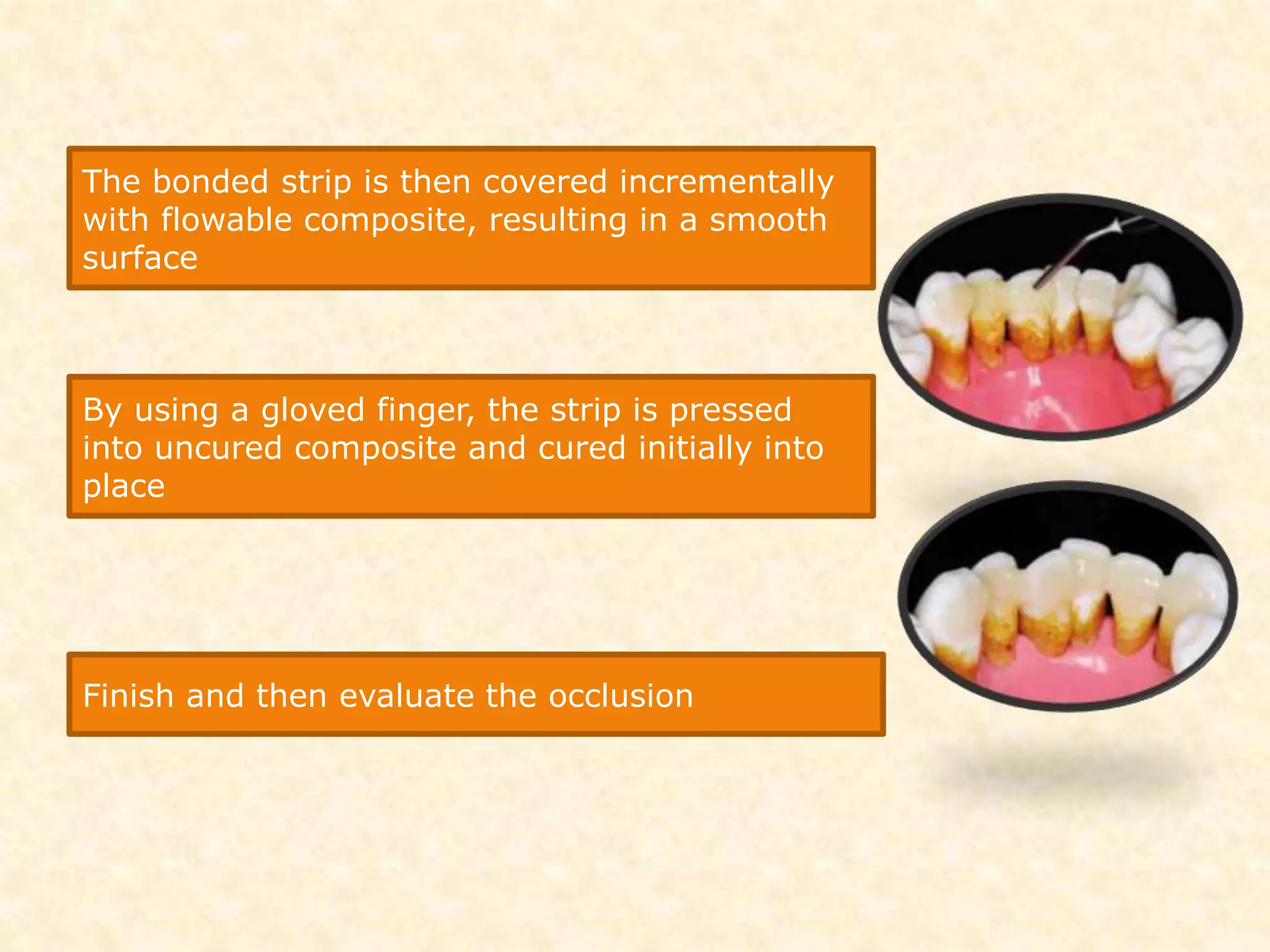 Dental splinting | PPTX
