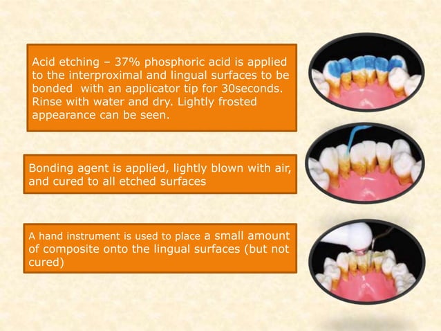 Dental splinting | PPTX