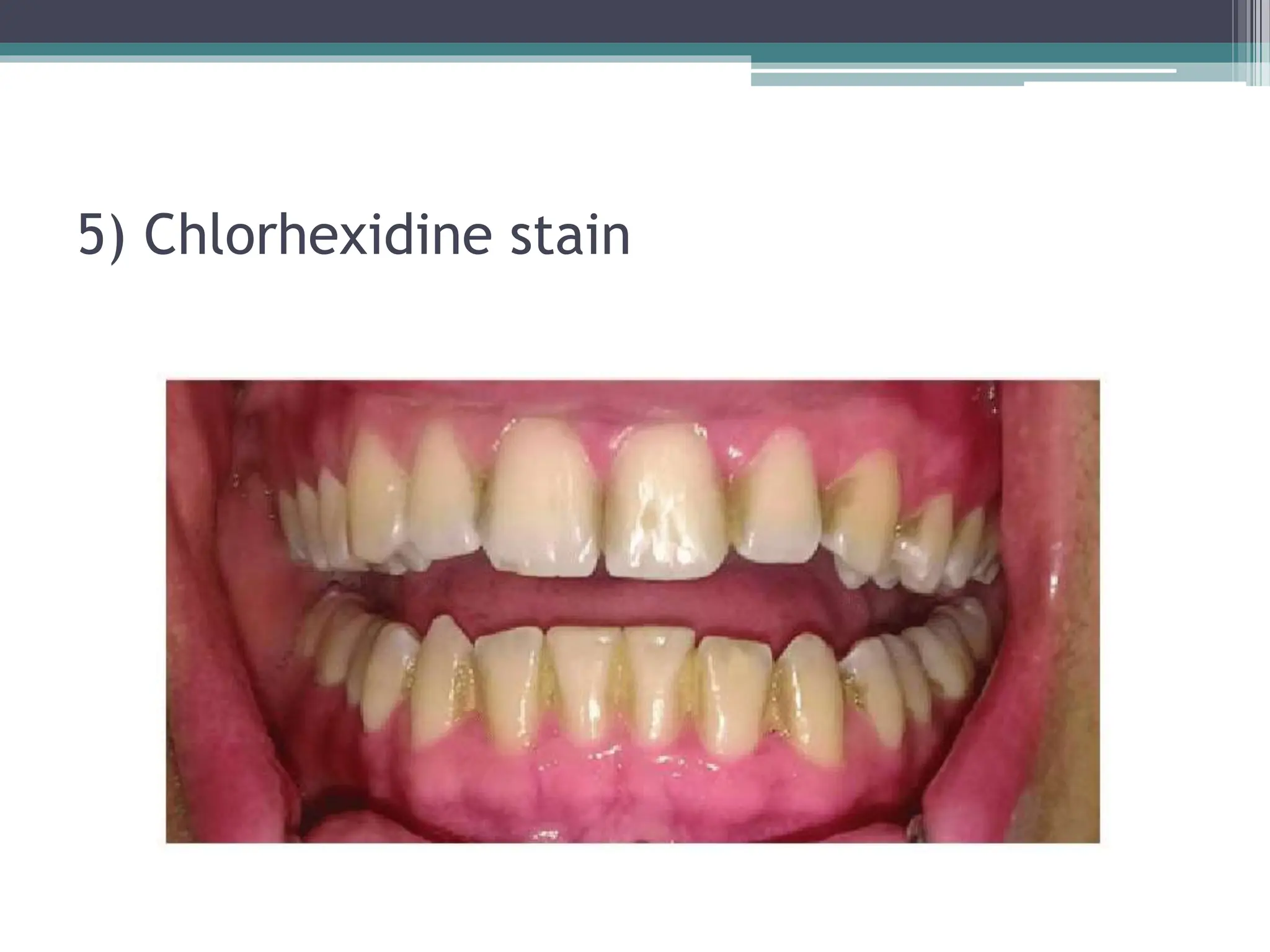 Dental stain ( Introduction , types , causes , treatment ).pptx