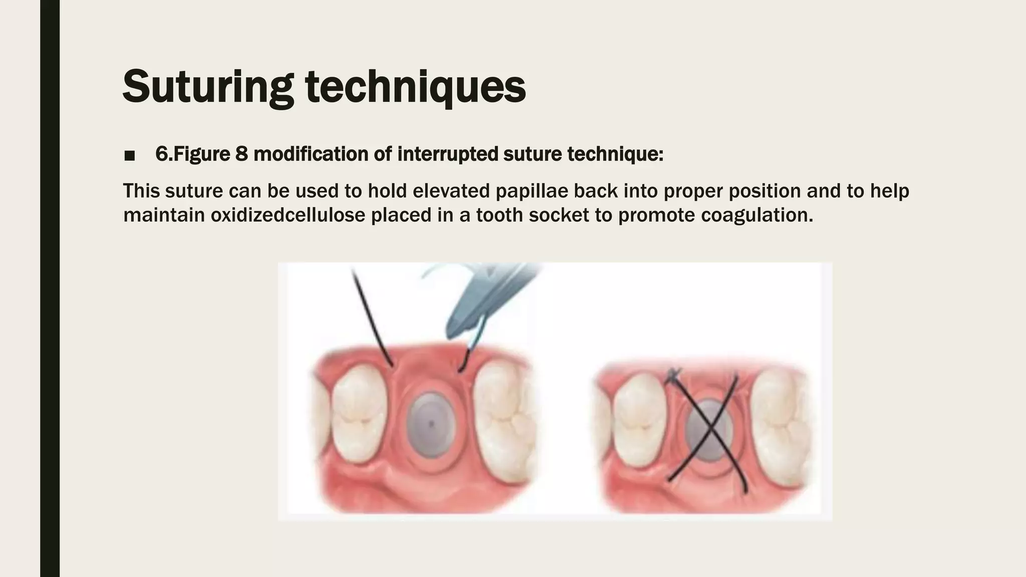 Dental suturing materials and techniques | PPTX