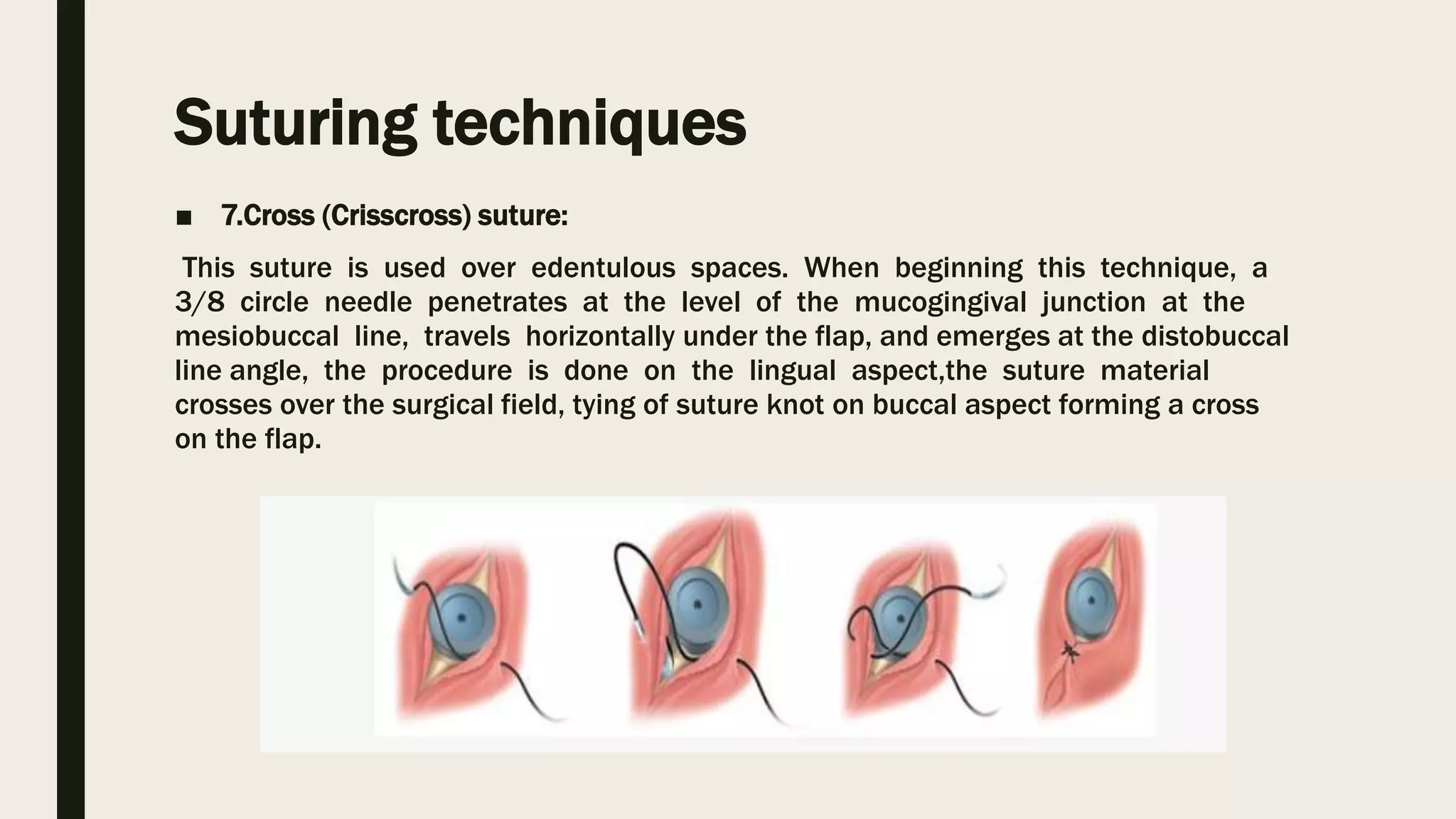 Dental suturing materials and techniques | PPTX