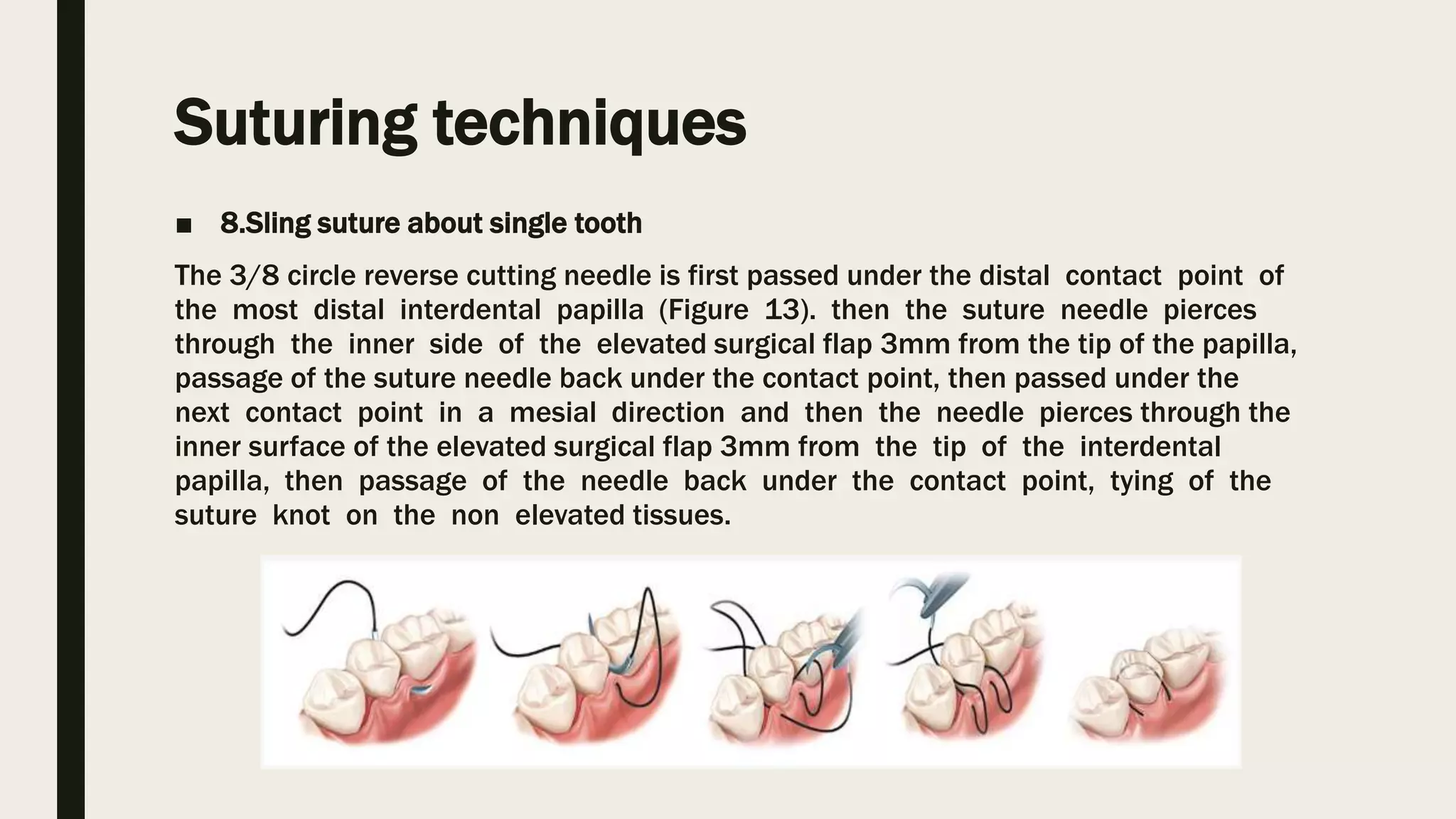 Dental suturing materials and techniques | PPTX