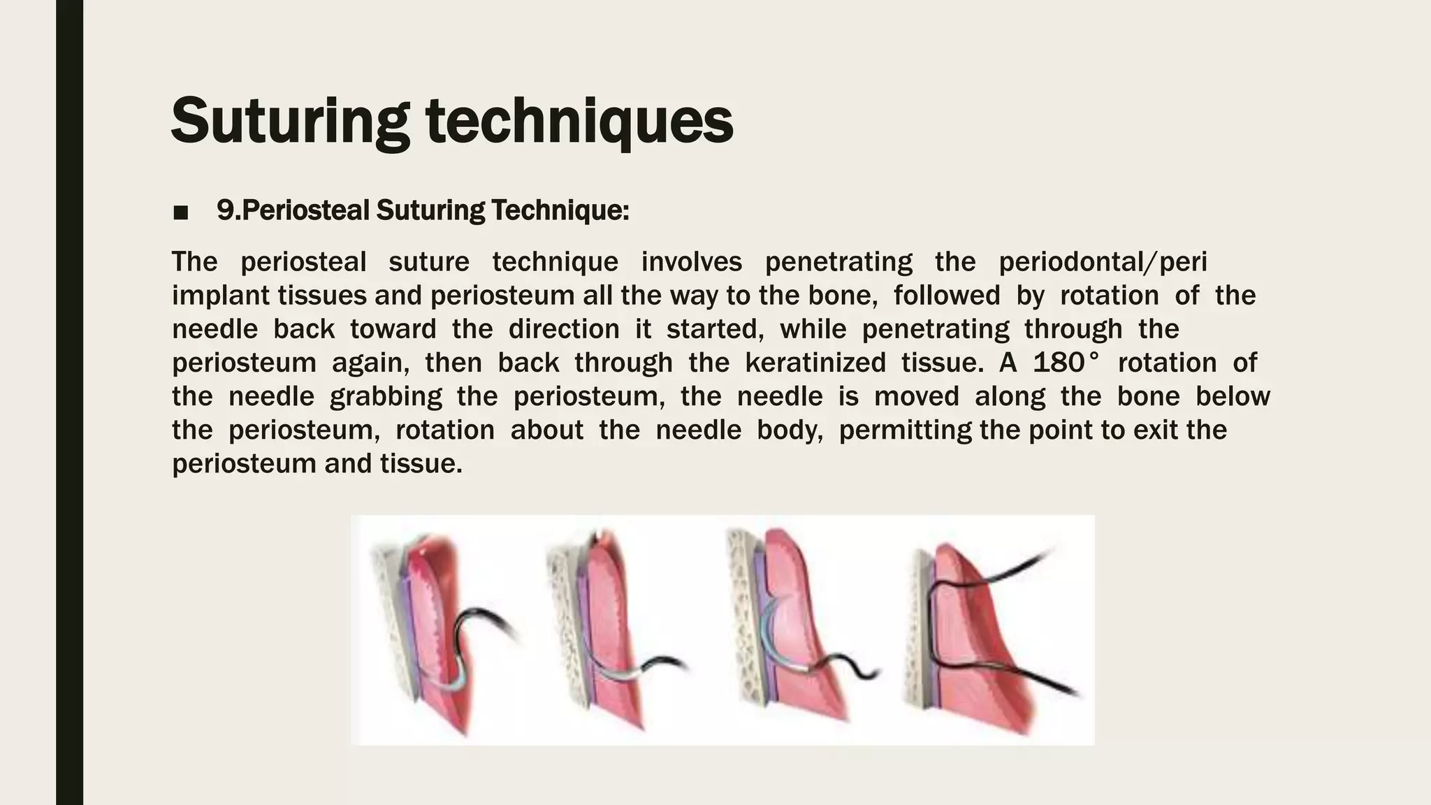 Dental suturing materials and techniques | PPTX