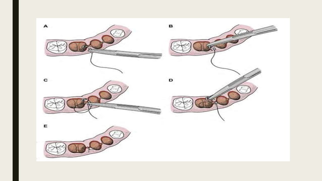 Dental suturing materials and techniques | PPTX