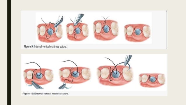 Dental suturing materials and techniques | PPTX