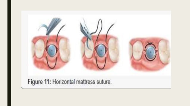 Dental suturing materials and techniques | PPTX