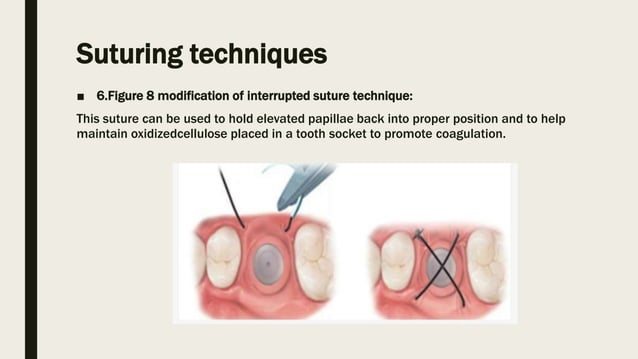Dental suturing materials and techniques | PPTX