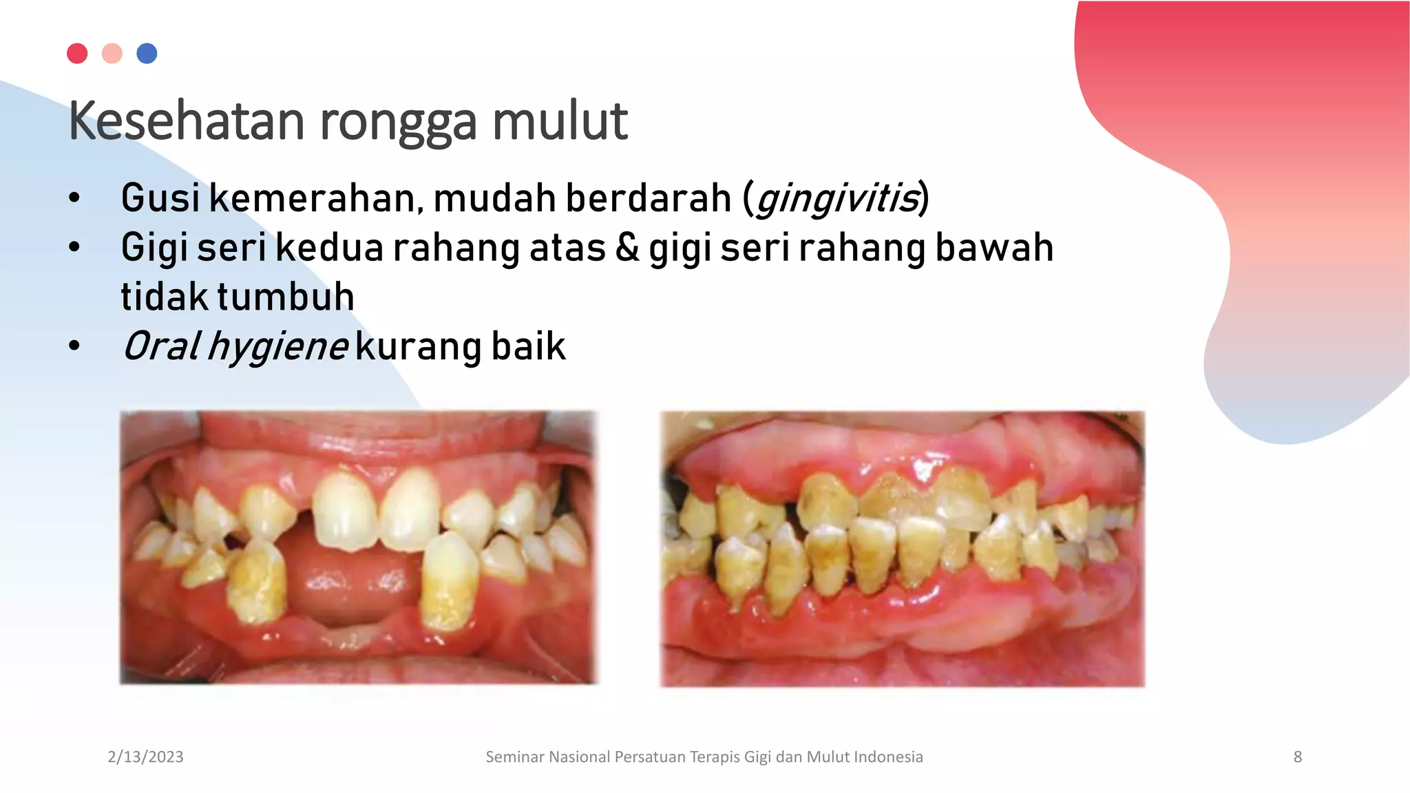 Masalah gigi pada ABK | PPTX