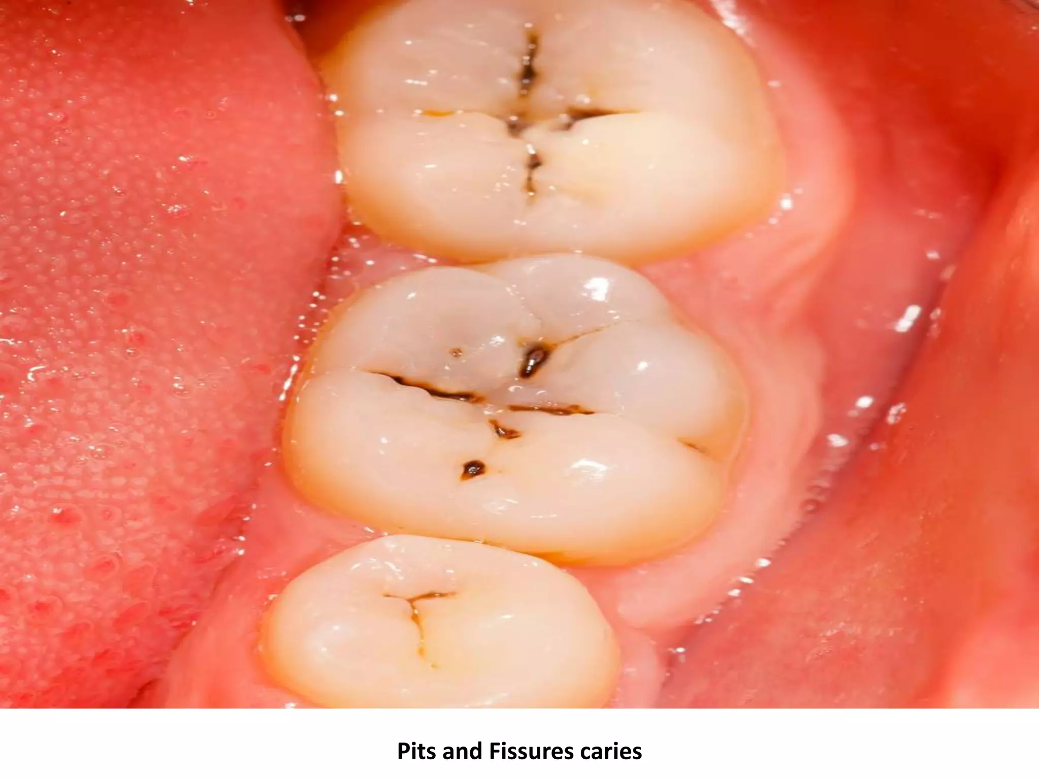Dental tooth nomenclature | PPTX