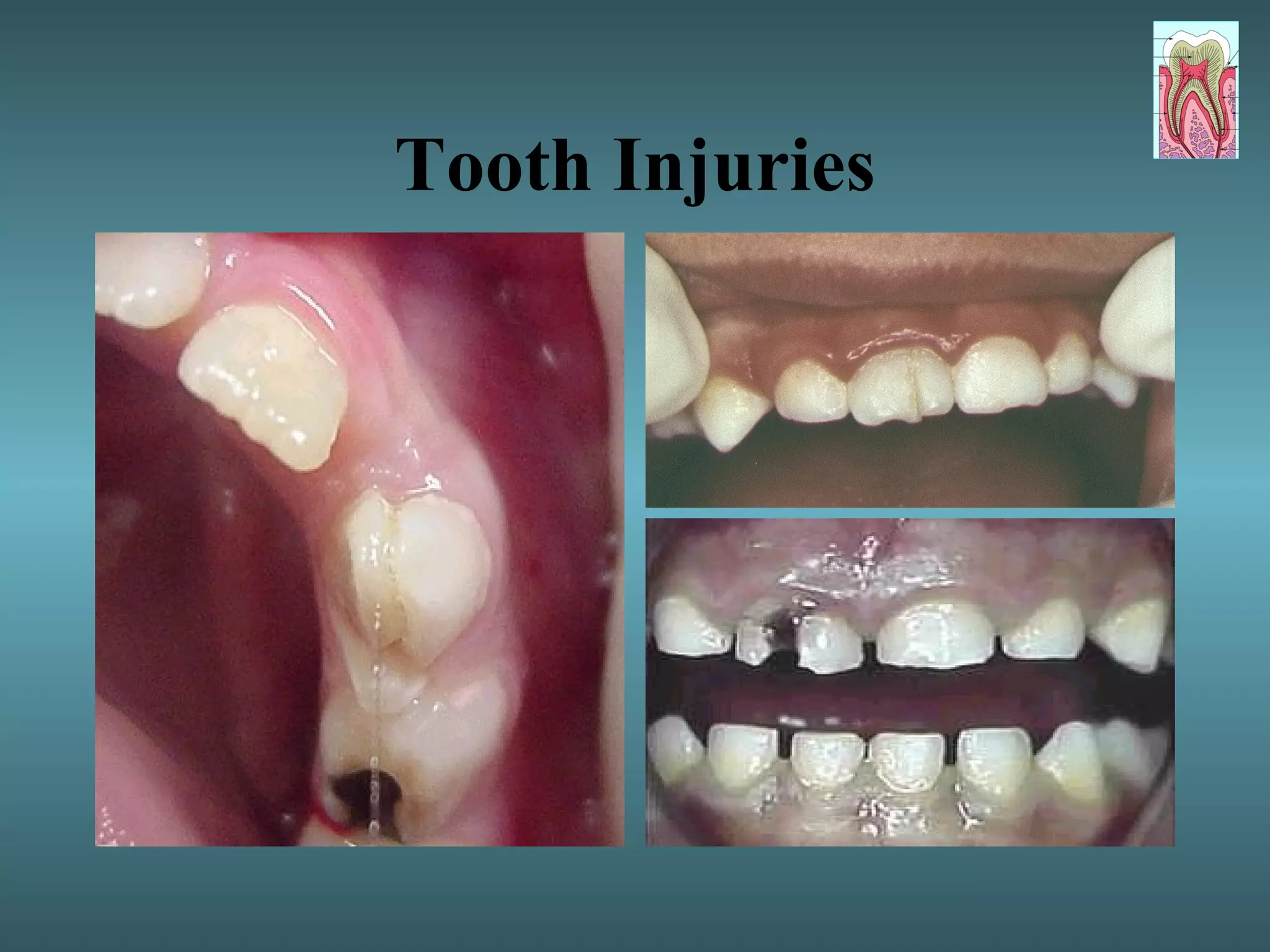 Dental Trauma | PPT