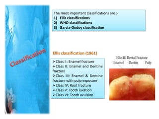 Dental trauma by Dr.mostafa Kareem | PPT