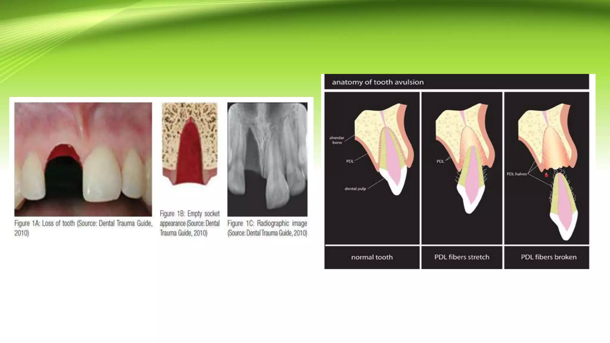 Dental trauma | PPTX