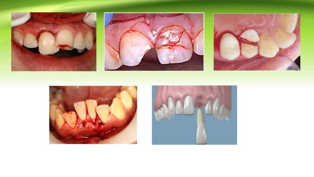 Dental trauma | PPTX