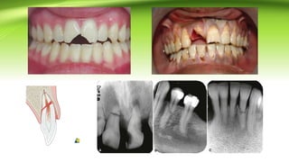 Dental trauma | PPTX