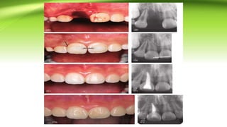 Dental trauma | PPTX