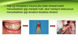 Dental trauma | PPTX