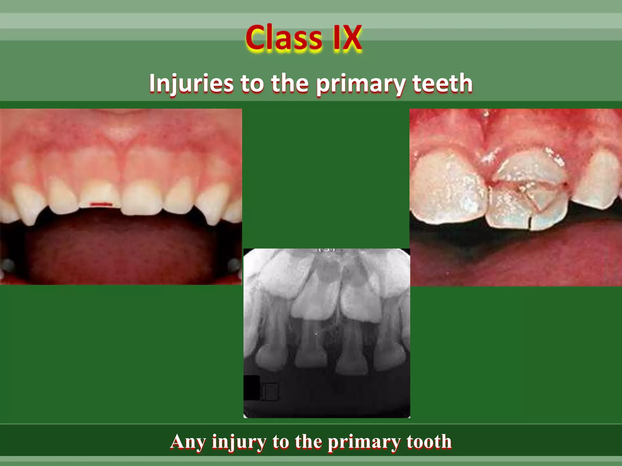 Dental Trauma.pptx