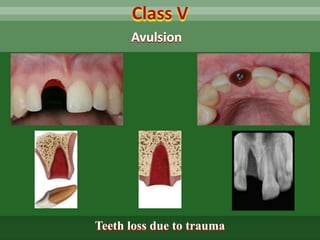 Dental Trauma.pptx | Dental Health | Diseases and Conditions