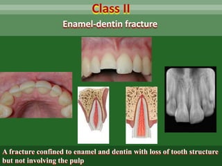 Dental Trauma.pptx | Dental Health | Diseases and Conditions