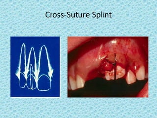 Dental Trauma.ppt