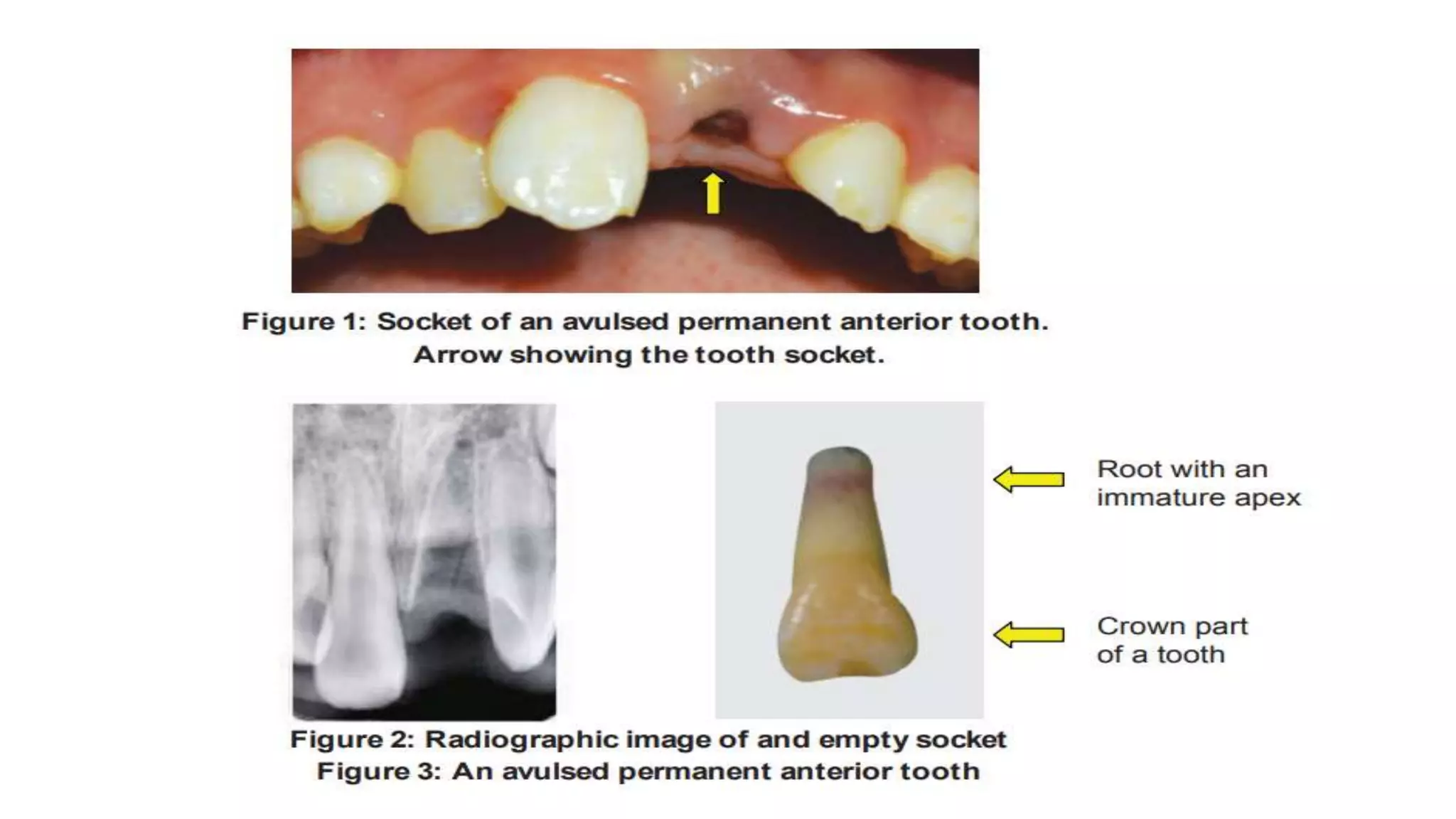 Pengurusan gigi kekal anterior yg teravulsi | PPTX