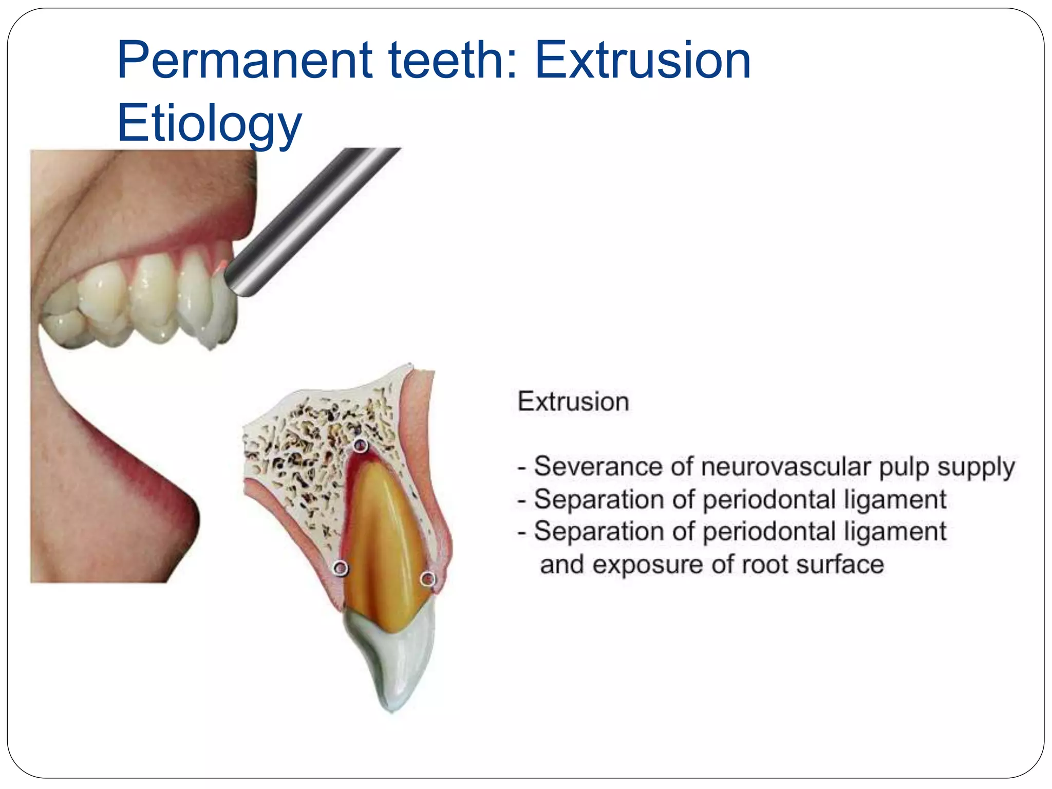 Dental trauma to permanent teeth | PPTX