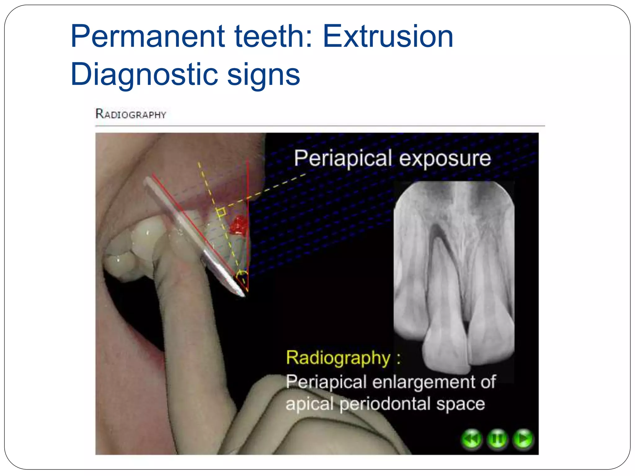 Dental trauma to permanent teeth | PPTX