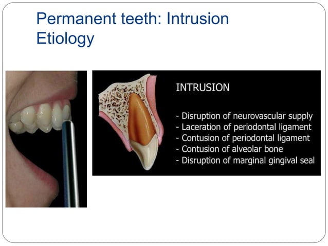 Dental trauma to permanent teeth | PPTX | Dental Health | Diseases and ...