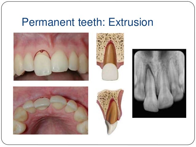 Dental trauma to permanent teeth