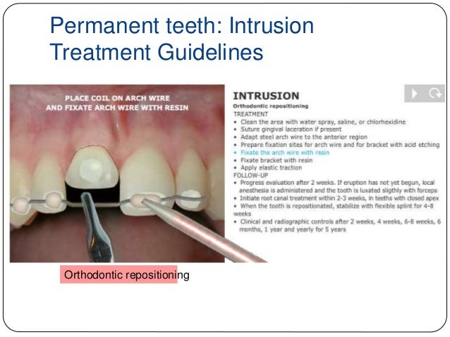 Dental trauma to permanent teeth