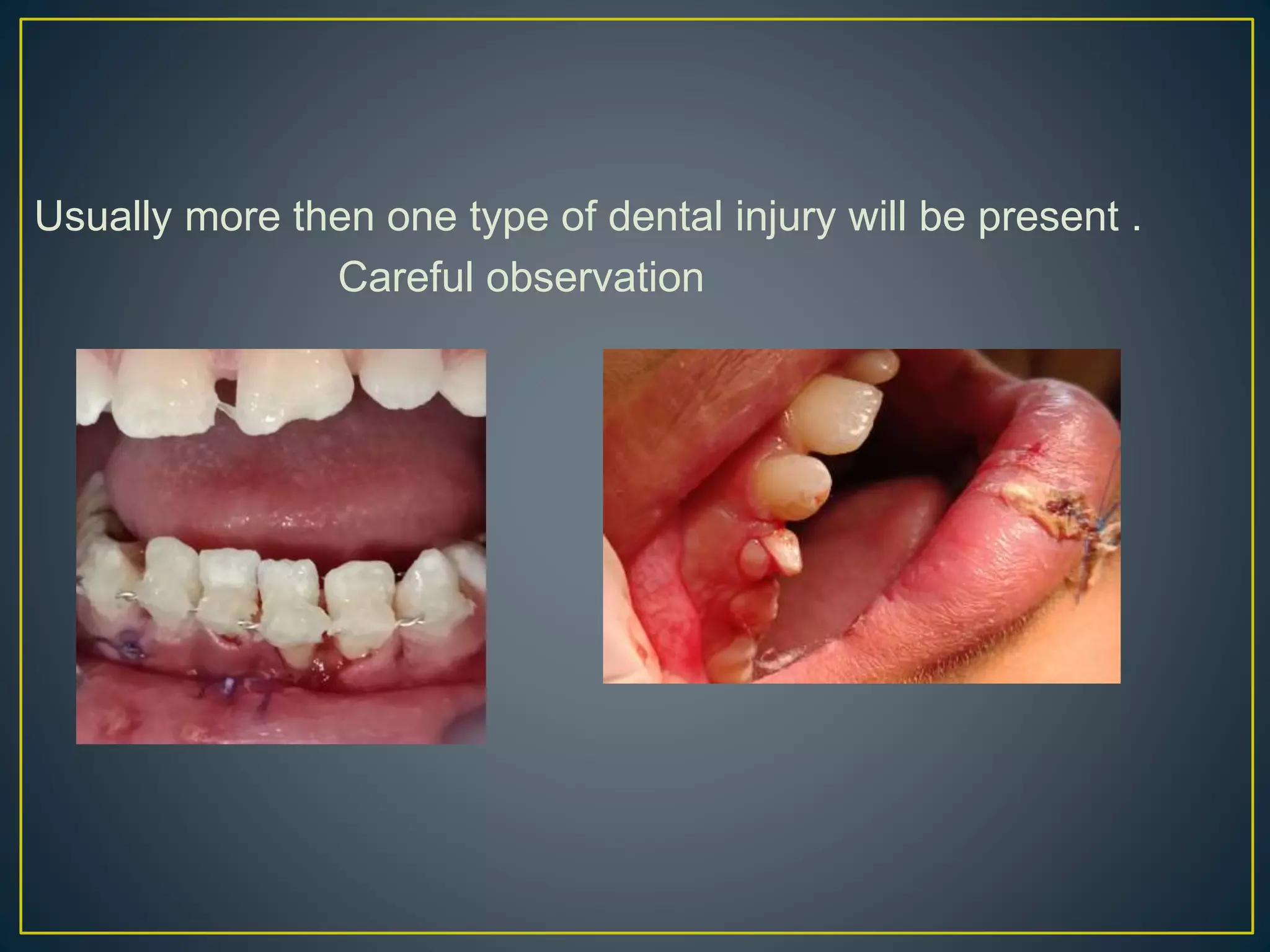 Dental Trauma to Permanent teeth | PPTX