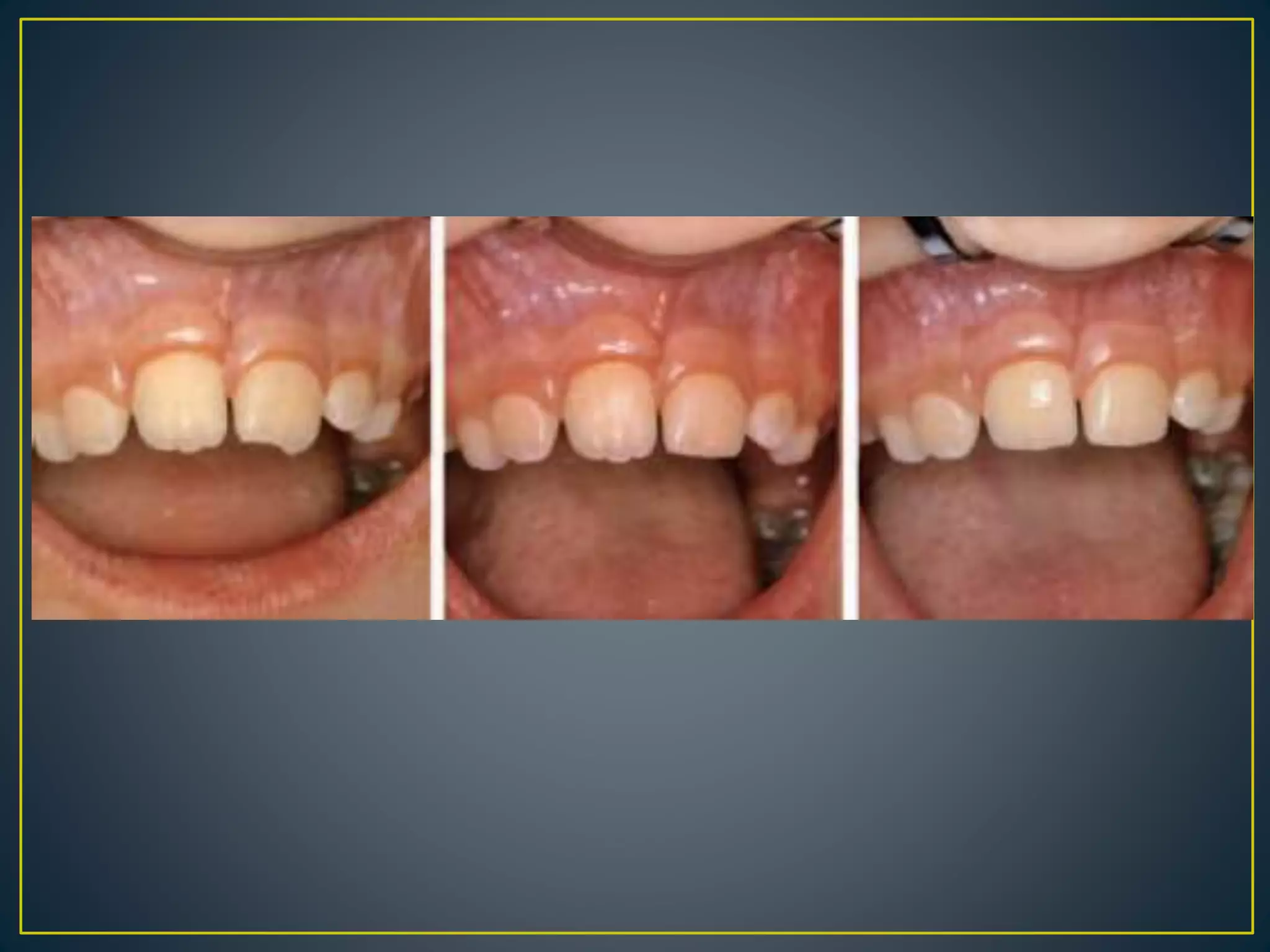 Dental Trauma to Permanent teeth | PPTX