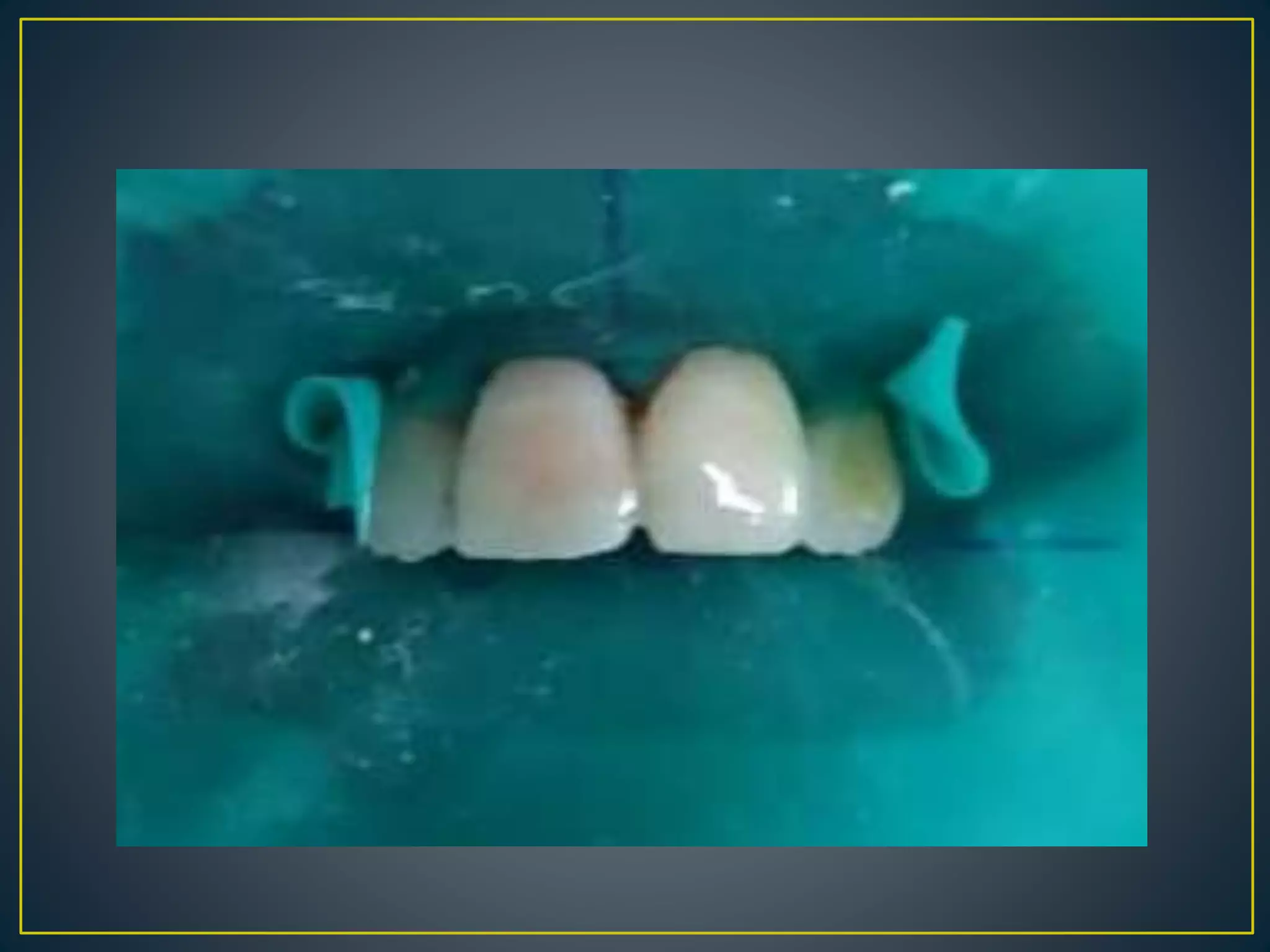 Dental Trauma to Permanent teeth | PPTX