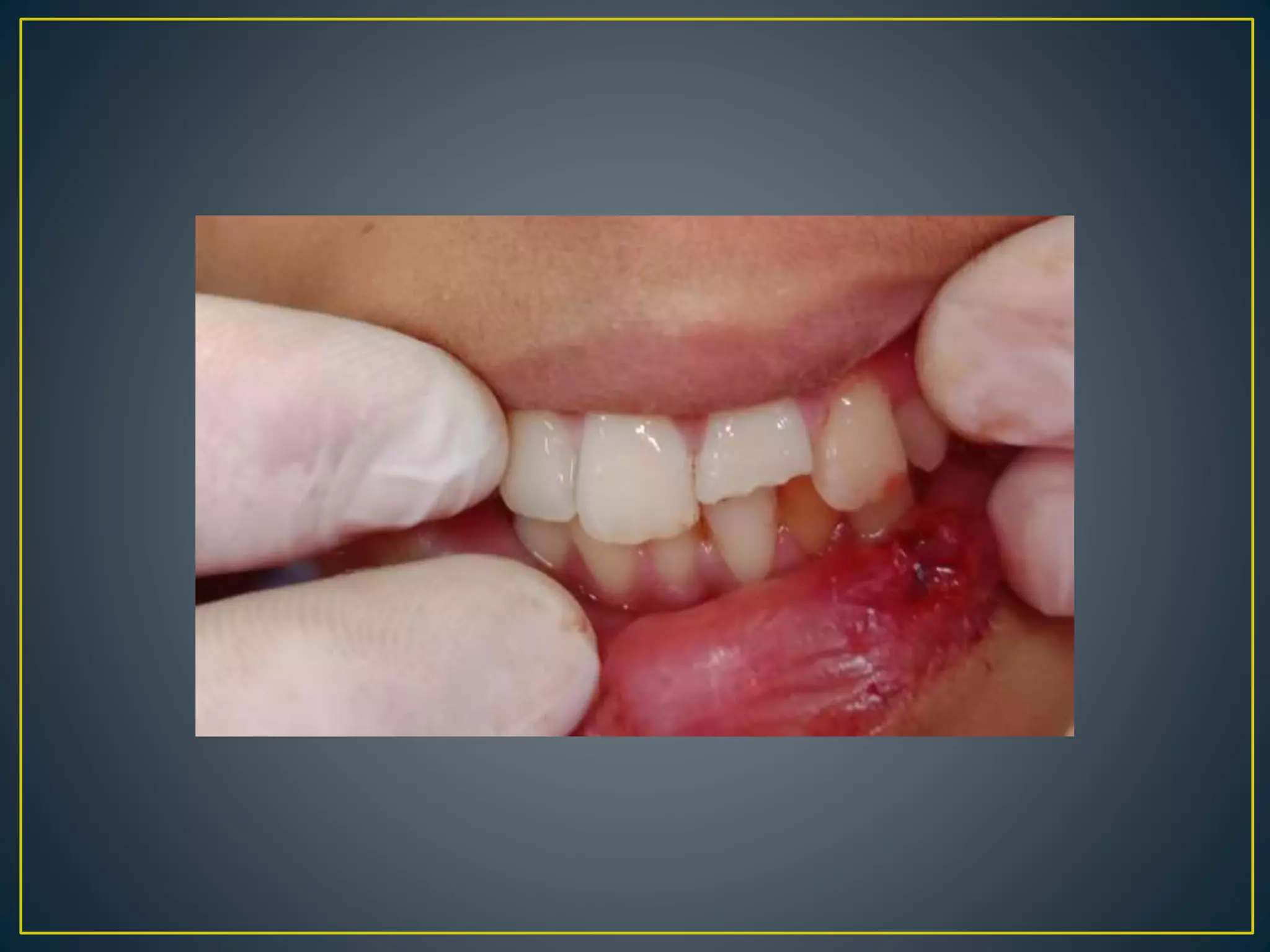 Dental Trauma to Permanent teeth | PPTX