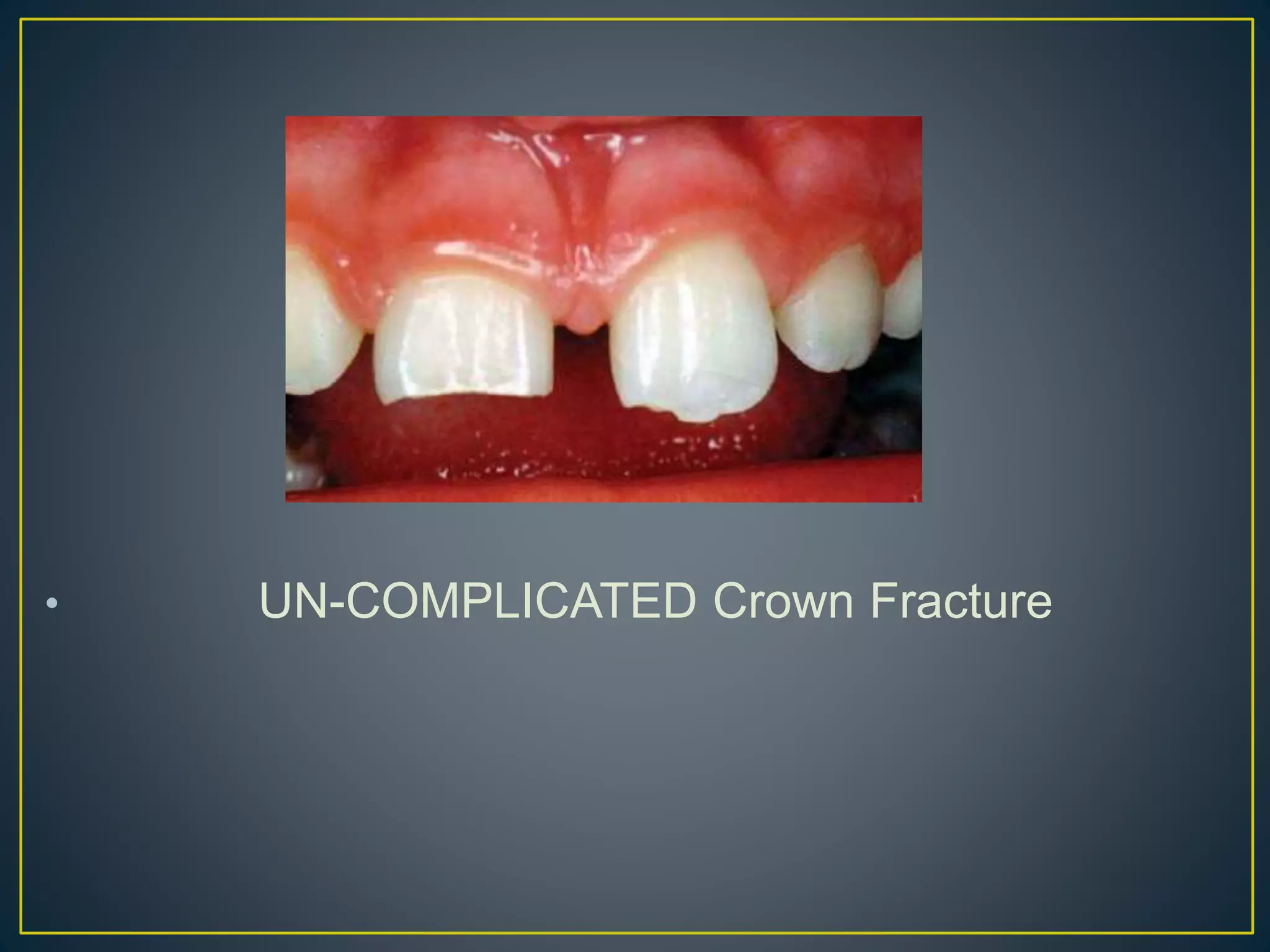 Dental Trauma to Permanent teeth | PPTX
